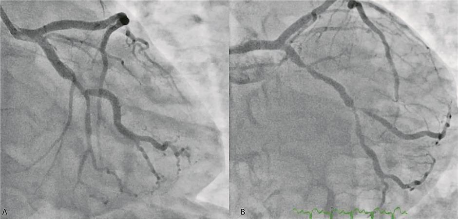 Bifurkationen: 1 oder 2 Stents setzen?