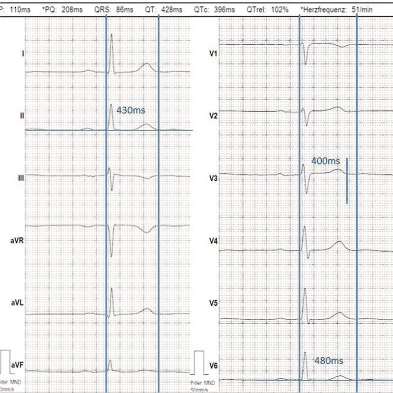 QT-Zeit beurteilen – trotz KI ist die menschliche Intelligenz noch gefragt!