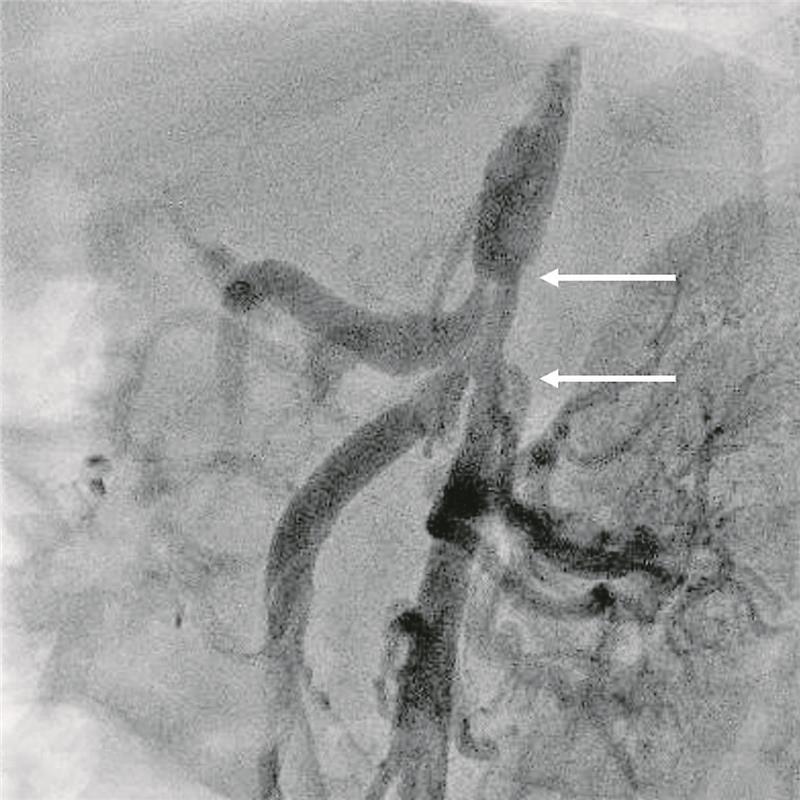 MAS: seltene Differenzialdiagnose der arteriellen Hypertonie