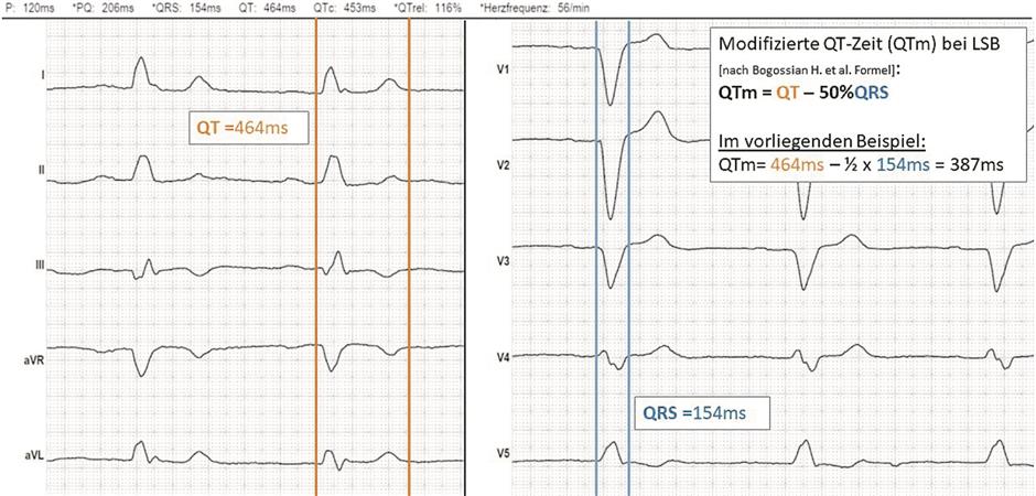 QT-Zeit beurteilen – trotz KI ist die menschliche Intelligenz noch gefragt!