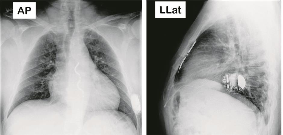 Substernaler ICD: Vorteile und Limitationen