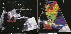 TAVI und TEER: Wenn Keime auf den Klappen wachsen