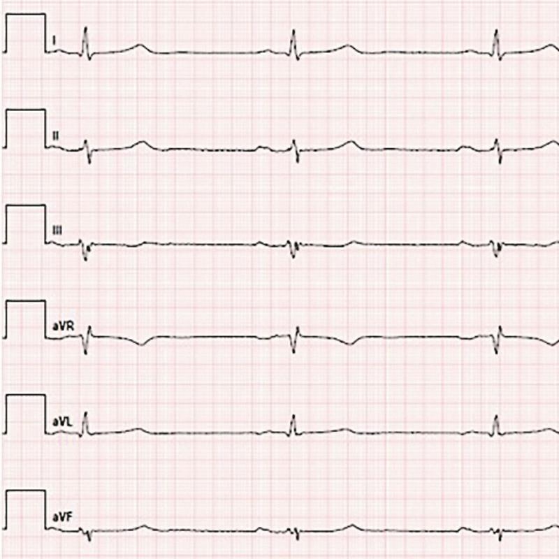 MINOCA – eine Herausforderung in der Diagnostik und Therapie