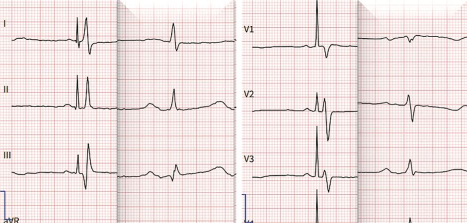 Conduction System Pacing – hot or not?