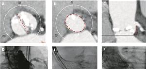 TAVI: bikuspide Aortenklappenstenose